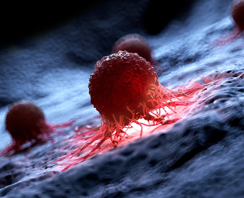 Przerzuty nowotworowe do kości - ST Medical Clinic